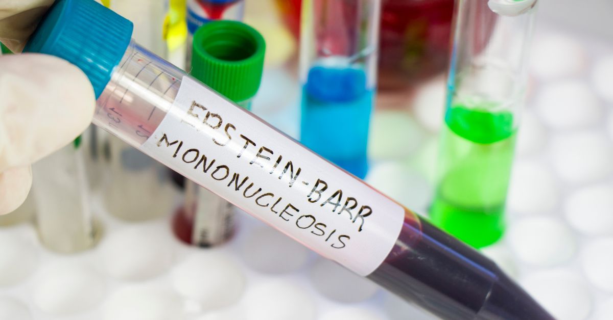 Mononucleosis – The Kissing Disease